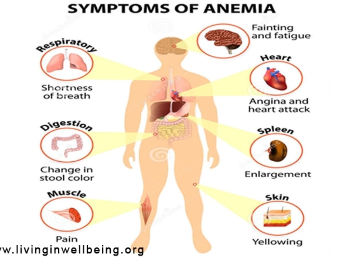 Anaemia Symptoms Shop Discounts | www.oceanproperty.co.th